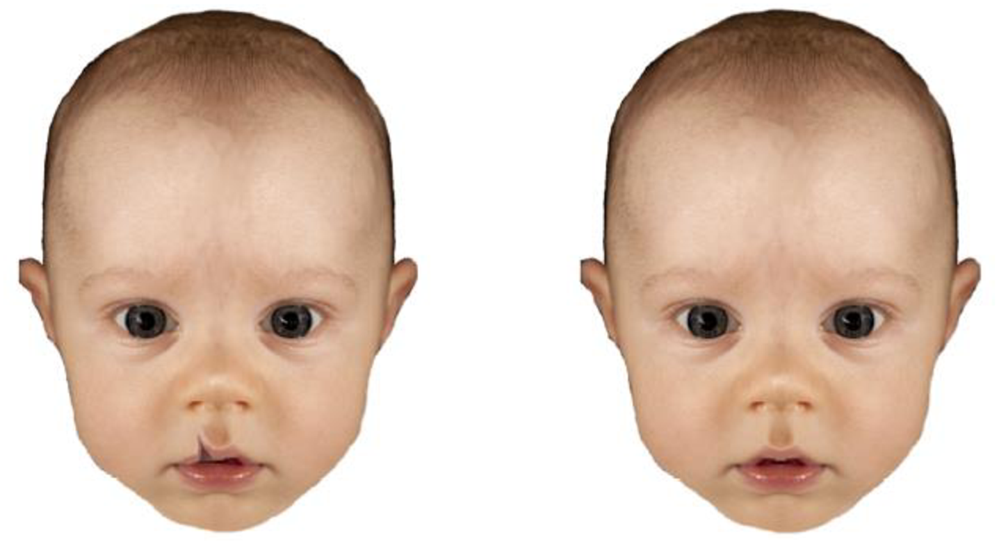 Effects on cleft lip on adults' perception of infants | Holly Rayson